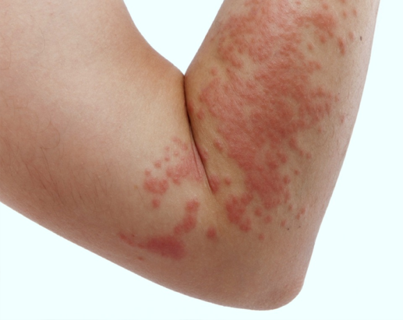 Cellulitis Skin Infections - Medical Consulting Company